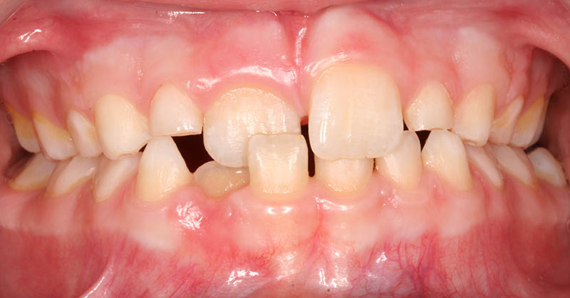 Glossary of Terms - Parkside Orthodontics