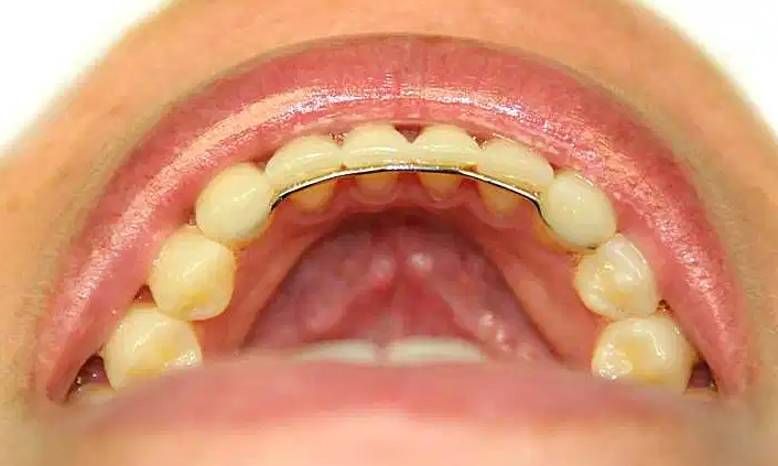 Orthodontic Retainers 101: What You Need to Know - Parkside Orthodontics