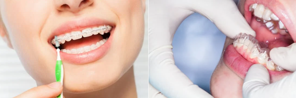 The Scoop on Getting Braces as an Adult - Parkside Orthodontics